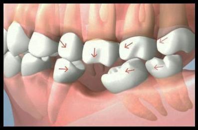 What Happens When Missing Tooth Does Not Get Replaced | Irvine CA